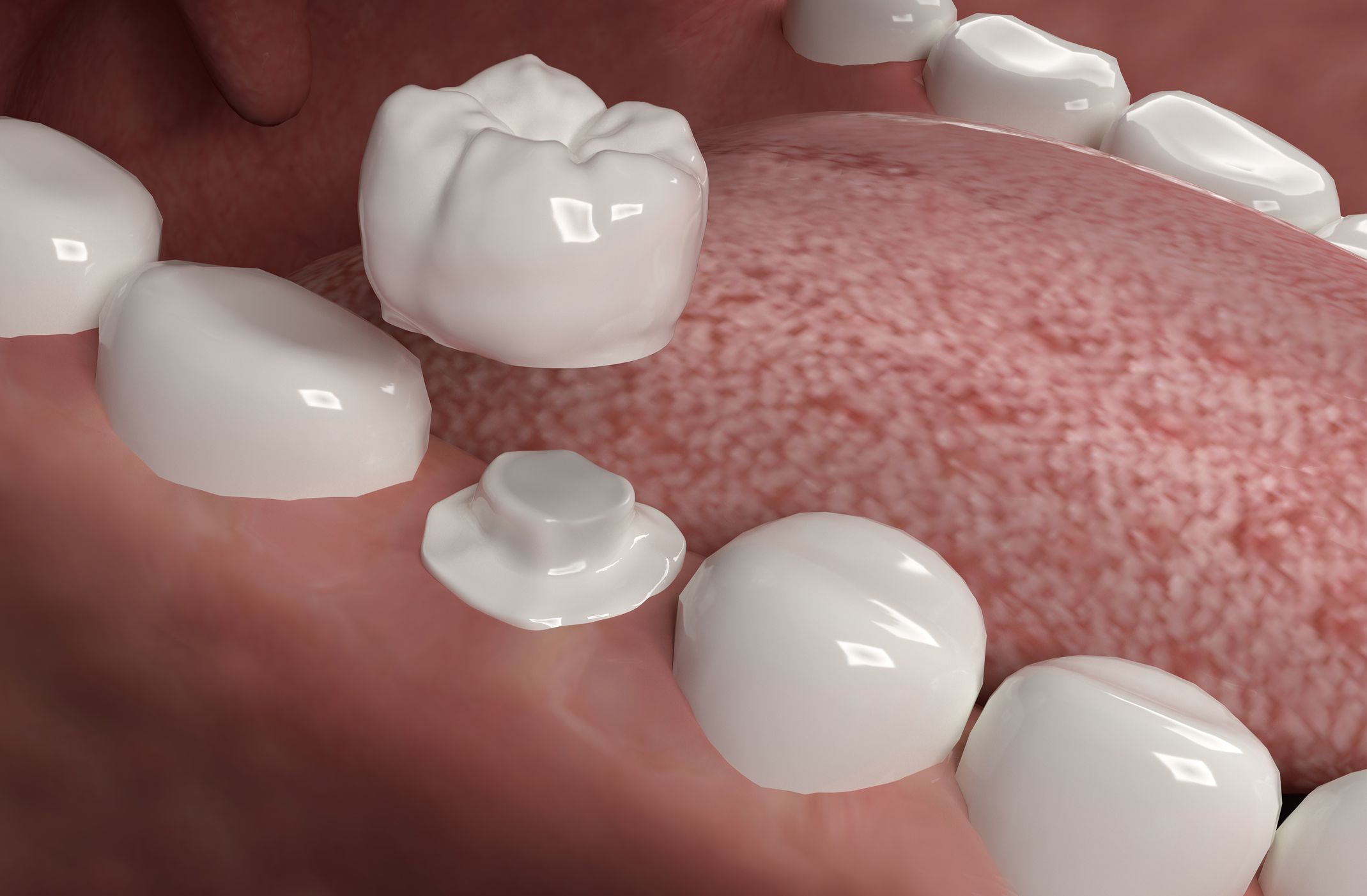🦷 Explore Dr. BestPrice | The Many Benefits of Dental Crowns
